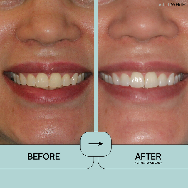 Prostrips Teeth Whitening Strips – intelliWHiTE